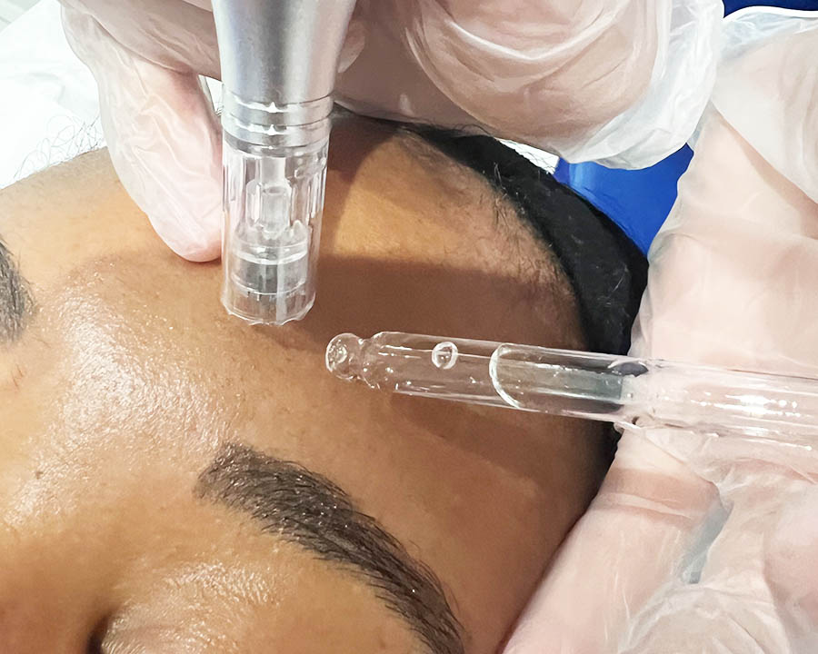 Microneedling - VIVO Body Studio in Mumbai